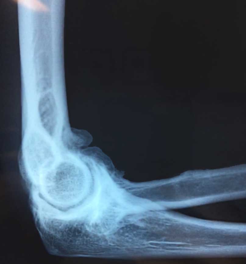 Elbow Osteoarthritis Dr Doron Sher Elbow Osteoarthritis Dr Doron Sher