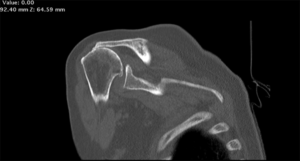 Rotator Cuff Tear Arthropathy | Dr Doron Sher