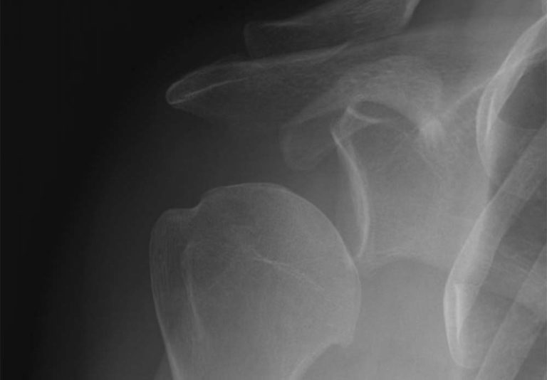 Shoulder Instability | Dr Doron Sher