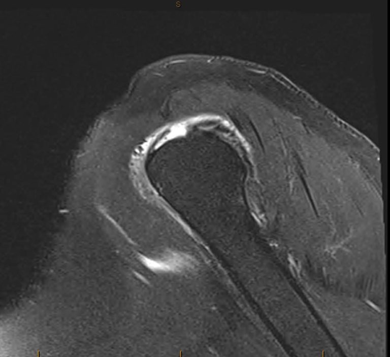 Rotator Cuff Tears | Dr Doron Sher